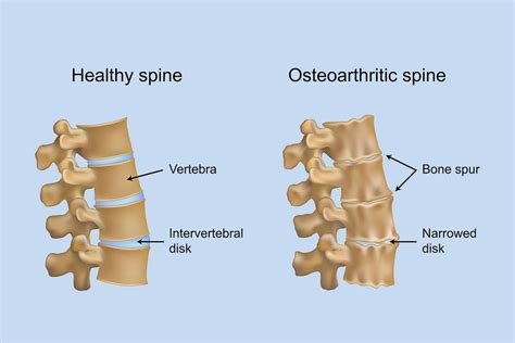 Osteoarthritis Of The Spine Osteoarthritis Of The Spine Pt And Me
