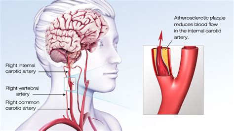 Transient Ischemic Stroke Symptoms