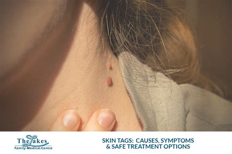 Skin Tags Causes Symptoms And Safe Treatment Options The Lakes