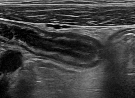 Abdomen And Retroperitoneum 1 5 Appendix Case 1 5 2 Uncomplicated Appendicitis Ultrasound