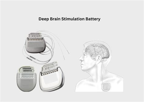 Deep Brain Stimulation Battery Replacement