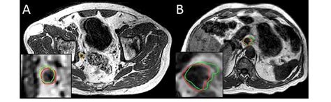 Example Cases Intra Fraction Target Motion Of Lymph Node Download