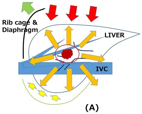 Laparoscopic Repeat Liver Resection—selecting The Best Approach For Repeat Liver Resection