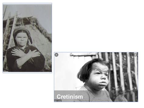 Thyroid Function Test Tft In Simple Way Ppt