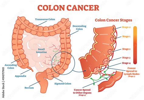 Colon Cancer Medical Vector Illustration Scheme Anatomical Diagram With Cancer Stages Stock