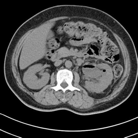 What Does Pyonephrosis Look Like On Ct Linta Kausar