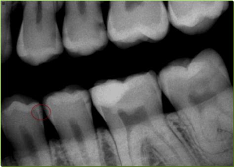 Radiographic Interpretation Of Dental Caries Flashcards Quizlet