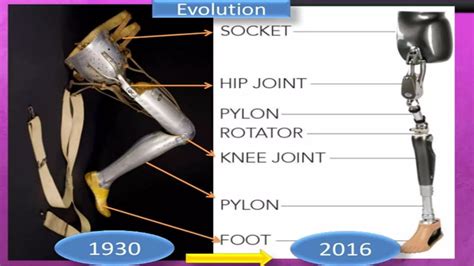 Hip Disarticulation Prosthetic Management Pptx