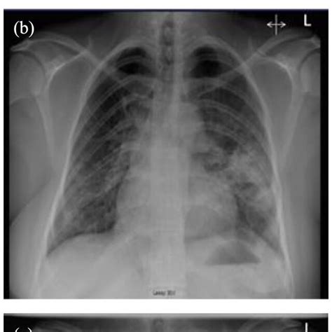 A Cxr Image Shows Diffuse Bilateral Airspace Consolidation With Download Scientific Diagram