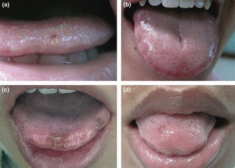 Pigmented Papillae