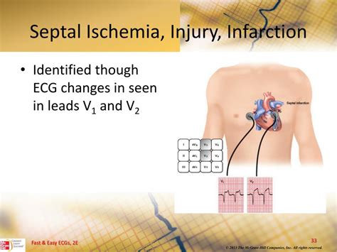 Ppt Myocardial Ischemia Injury And Infarction Powerpoint