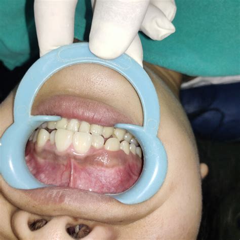 Swelling Present Over The Left Maxillary Sinus In The Nasofacial Region