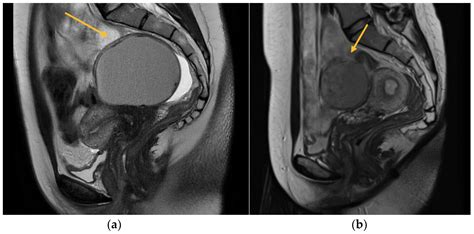 Transvaginal Ultrasound Vs Magnetic Resonance Imaging What Is The