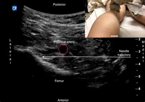 Ipack Injection In Prone Position With Corresponding Sonogram