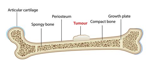 Bone Cancer Healthdirect