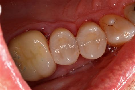 Class Ii Composites Sub Gingival Margin Large Embrasure And Cusp Overlay Dental Case Of The Day