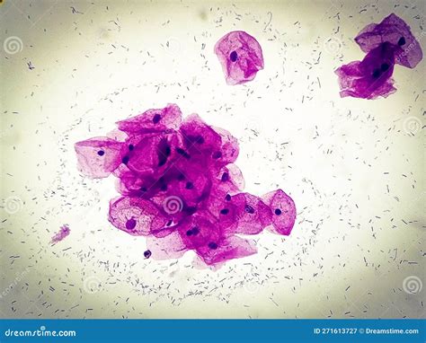 Spindle Cells In Pap Smear At Jennifer Hubbard Blog