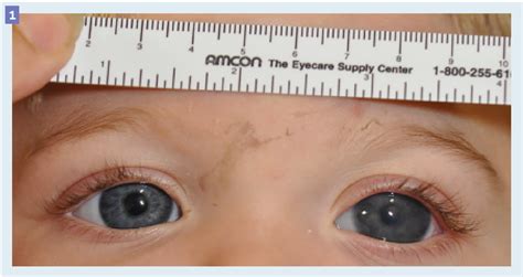 The Complicated Ins And Outs Of Pediatric Glaucoma