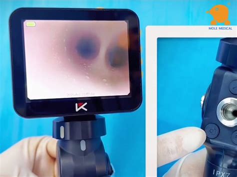 Double Lumen Endotracheal Tube Placement Guide Laryngoscopemole