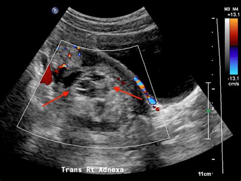 Transverse View Of The Pelvic Ultrasound Showing The Heterogeneously