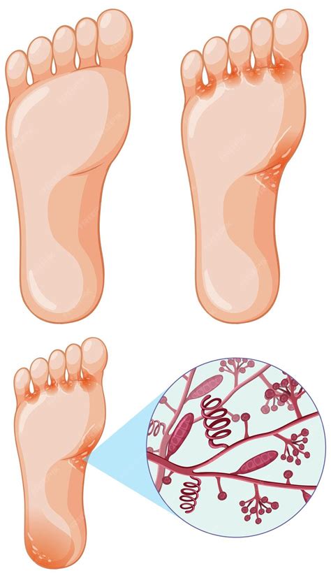 Free Vector Trichophyton Rubrum Fungal Infection