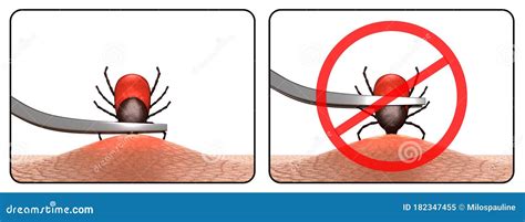 How To Remove A Tick The Correct Way Using Forceps 3d Rendering