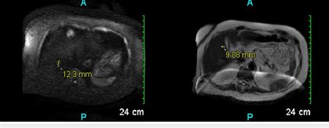 Magnetic Resonance Imaging Revealed Two Echogenic Foci In The Liver Download Scientific Diagram