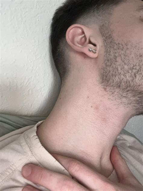 Can Anyone Identify These Rashes Rdermatologyquestions