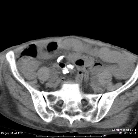 Vaginal Prolapse Complicated By Obstructive Uropathy Radiology Case Radiopaedia Org