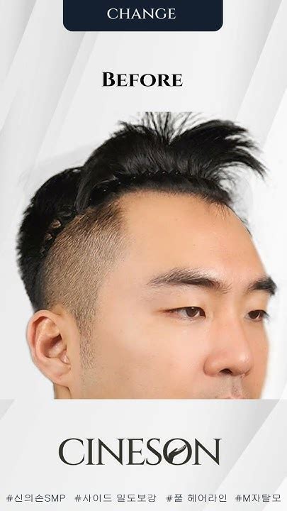 M자 탈모 소프트 헤어라인으로 부드럽고 자연스럽게 탈모탈출 M자탈모 탈모 두피문신 Smp 연신내 은평구두피문신 상암동 홍대두피문신 그레이시티