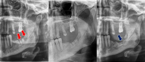 Cropped Panoramic Radiographs Of A 49 Year Old Female Patient