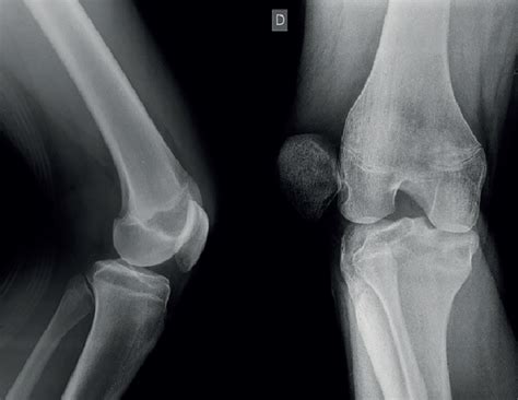 Manejo De Las Fracturas Osteocondrales De La Rodilla Fondoscience
