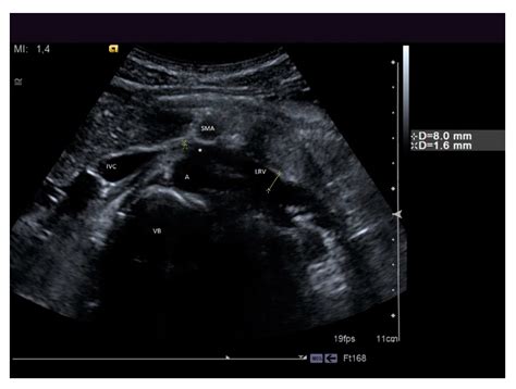 Nutcracker Syndrome And Pots At Sarita Sturgeon Blog