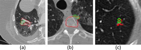 Visual Examples Of Pulmonary Nodule Segmentation Results On Which The