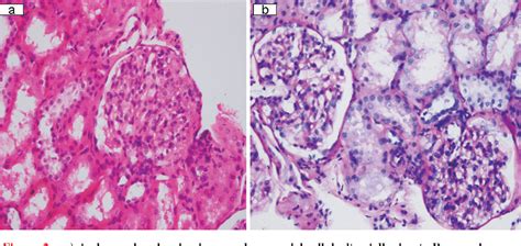 Figure 1 From Treatment Of A Case Of Mesangioproliferative Glomerulonephritis Secondary To