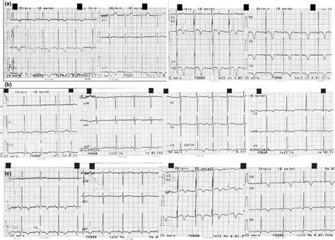 A Electrocardiogram Before Treatment B Electrocardiogram During