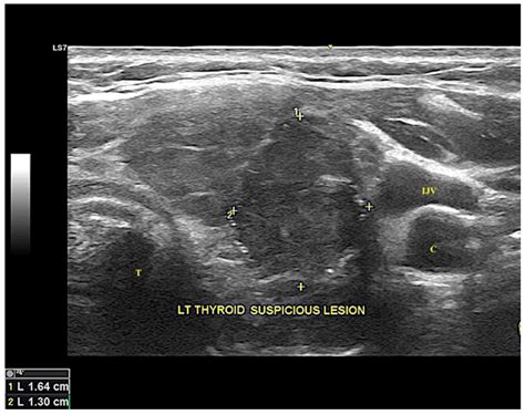 Papillary Thyroid Cancer Ultrasound