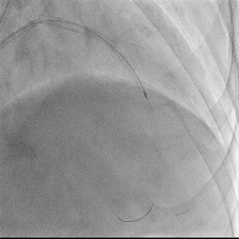 Rotational Atherectomy With 1 25mm Burr To Mid Lad Download Scientific Diagram