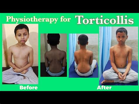 Cervical Dystonia Exercises The Extreme Ends Of The Treatment Response