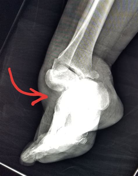 North Broward Radiologists Ankle Xray Subtalar Dislocation After Car Accident Radiologist