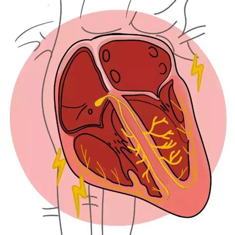 AkutnĚcz Syndrom Dlouhého Qt Intervalu