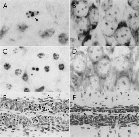 A Pyriform Cortex Days P I With CVS Showing Multiple Condensations Download Scientific