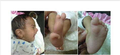 The Case Number 130 Of Townes Brocks Syndrome