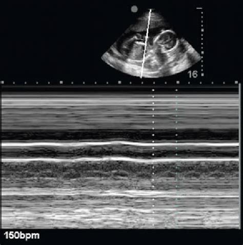 How To Measure Fetal Heart Rate Fycb