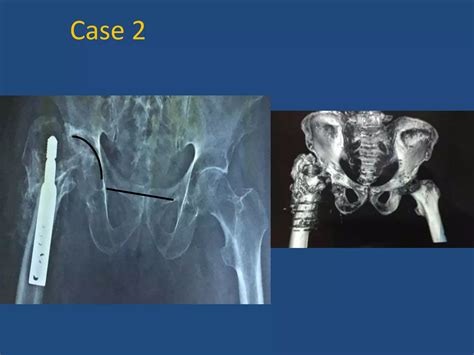 Acetabular Defects Pptx