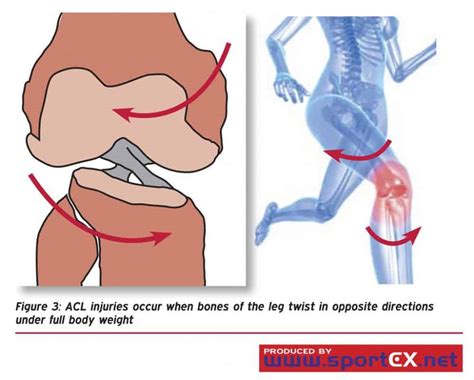 How And When To Use An Acl Brace Physioroom Blog