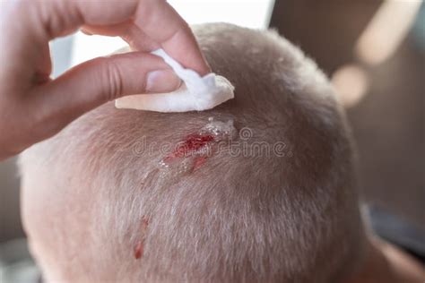 Injury To The Scalp Blood Leaks From A Chopped Wound On The Head Stock