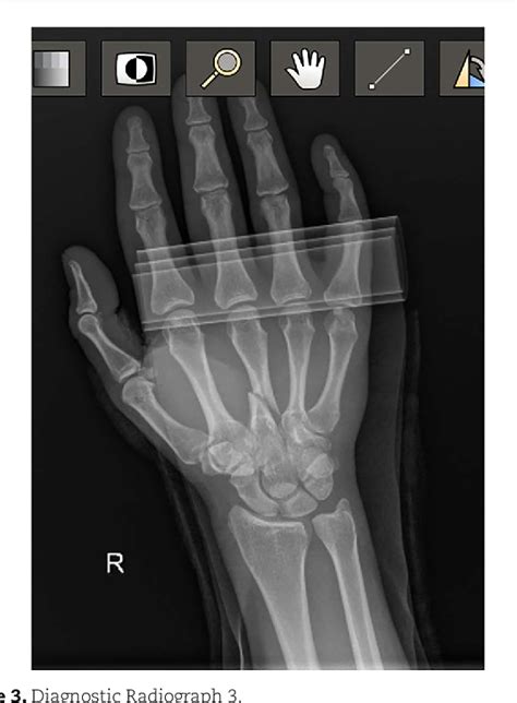 Figure 1 From Management Of A Metacarpal Oblique Fracture In An Elite Cyclist Semantic Scholar