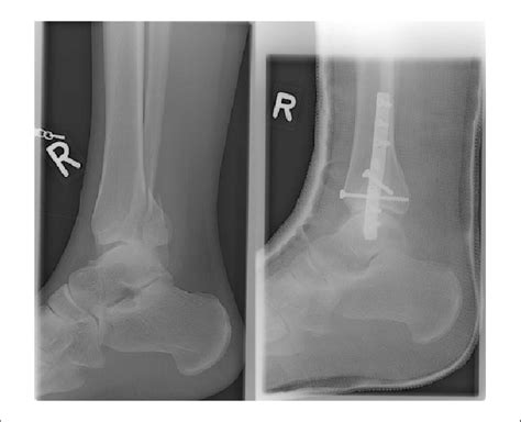 Ankle Fracture Involving Posterior Malleolar Fracture Fragment Fixed By