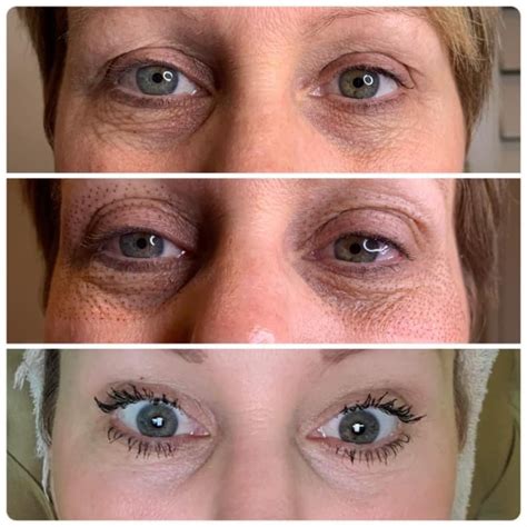 Plasma Fibroblast Before And After Skintutive Medspa